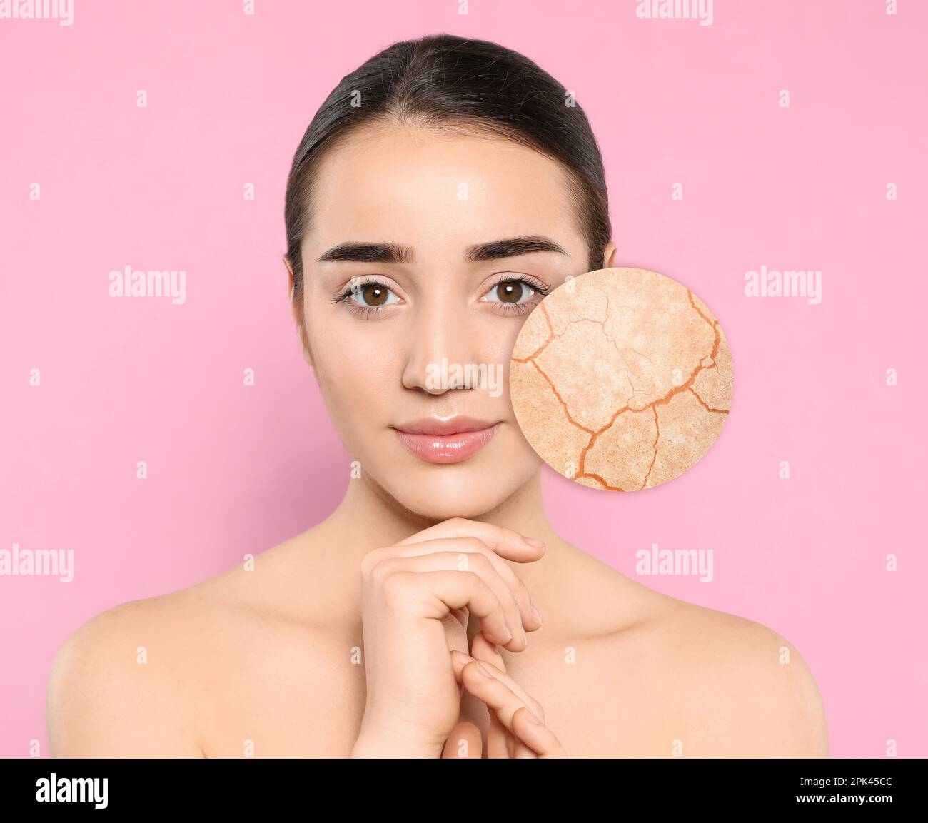 Ichthyosis hi-res stock photography and images - Alamy