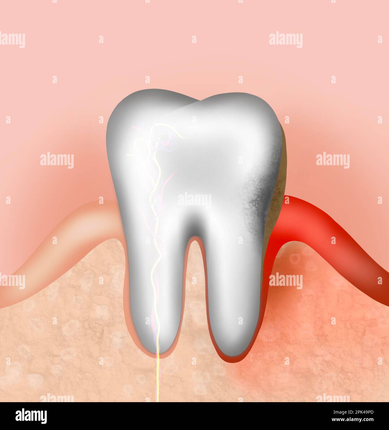 Infected gum and tooth, illustration. Periodontal disease Stock Photo ...