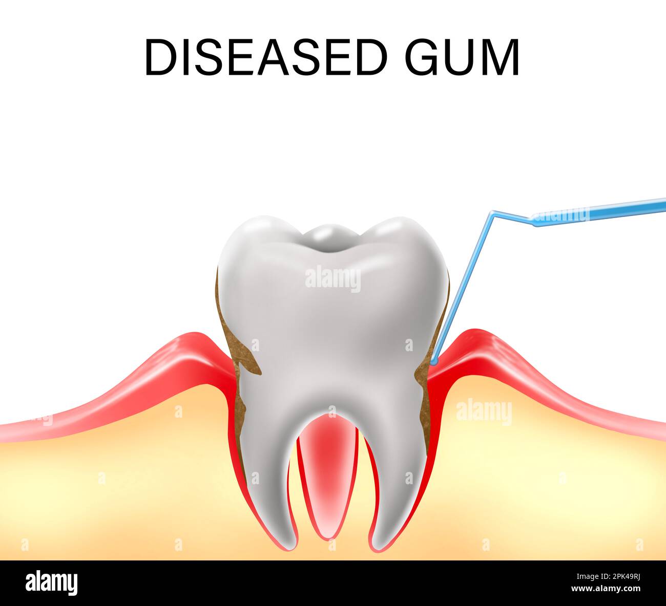 Infected gum and tooth, illustration. Periodontal disease Stock Photo ...