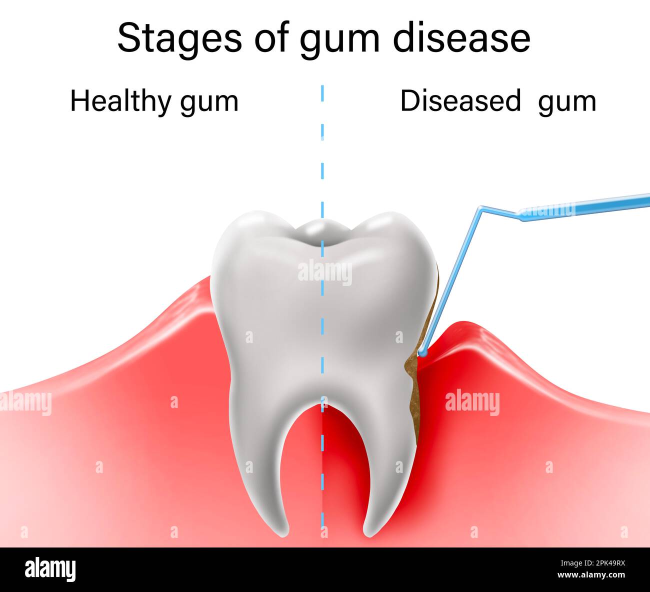 Collage with illustrations of healthy tooth with gum and diseased ones ...