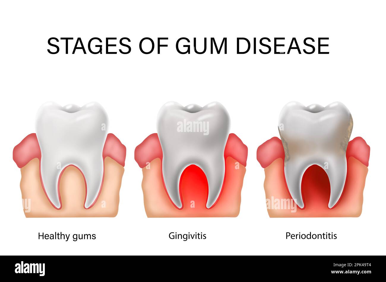 Collage with illustrations of healthy tooth with gum and infected ones ...