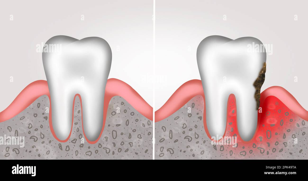 Collage with illustrations of healthy tooth with gum and diseased ones ...