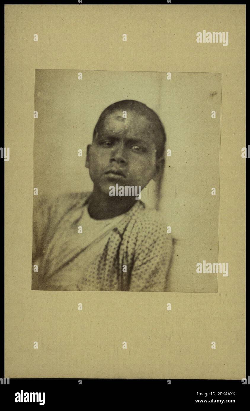 Photograph from Photographs of Cases of Leprosy. Accompanying Reports ...