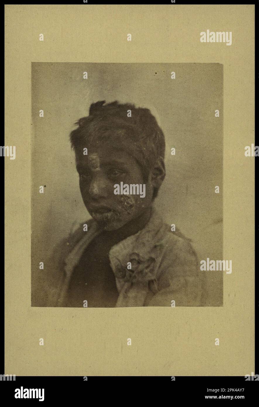 Photograph from Photographs of Cases of Leprosy. Accompanying Reports ...