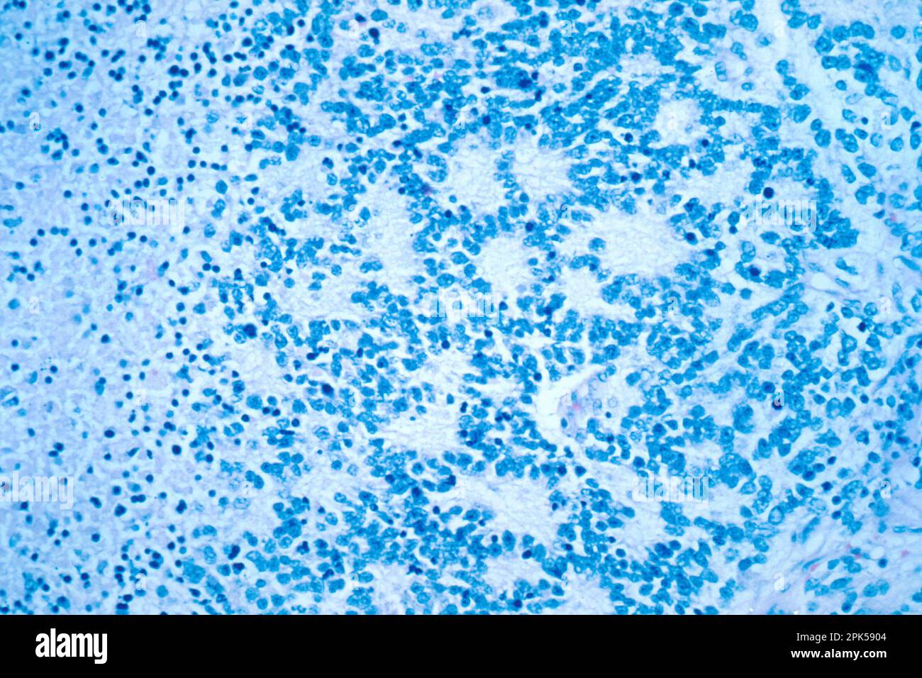 This December 1993 microscope photo provided by the National Cancer ...