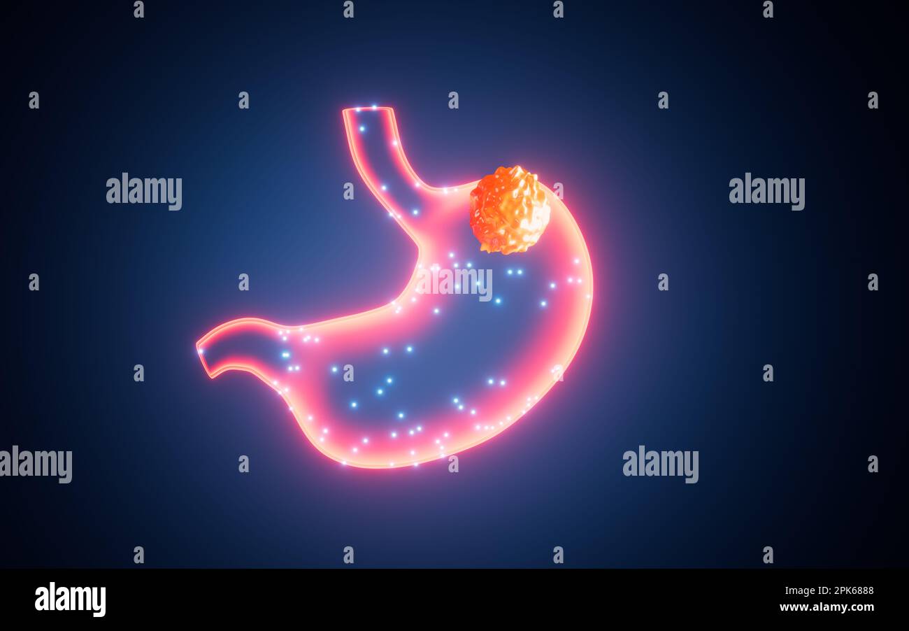 Human stomach cancer, gastric cancer, 3d rendering. Digital drawing ...