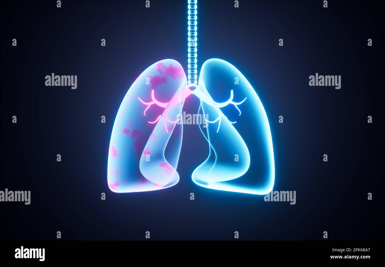 Diseased human lungs, human respiratory diseases, 3d rendering. Digital ...