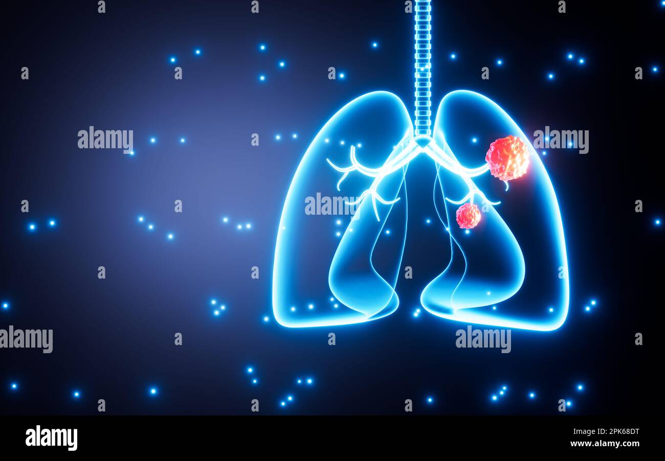 Human lung tumor, human lung cancer, 3d rendering. Digital drawing ...