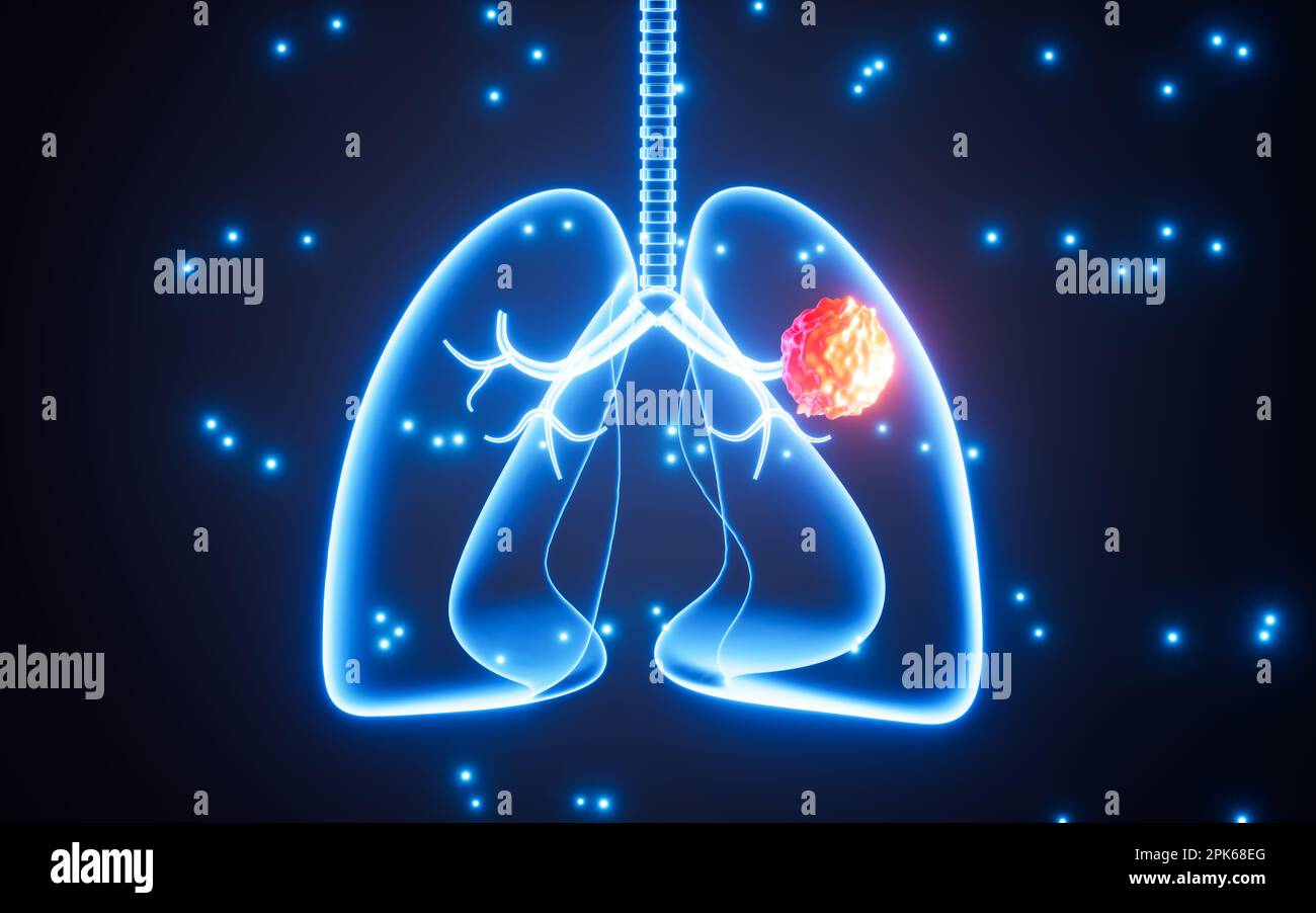Human lung tumor, human lung cancer, 3d rendering. Digital drawing ...