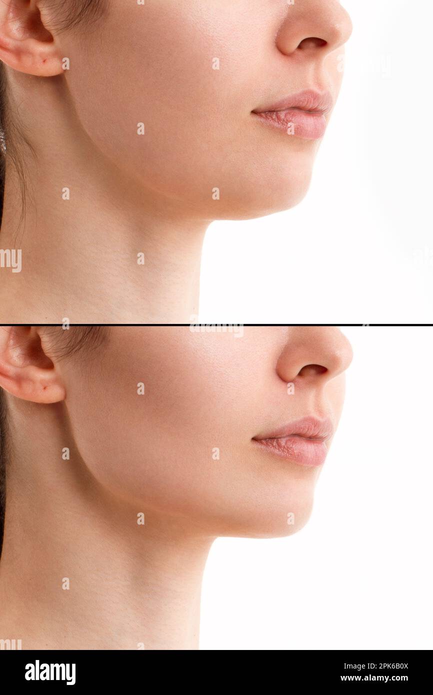 Close-up portrait of a woman before and after a chin correction ...