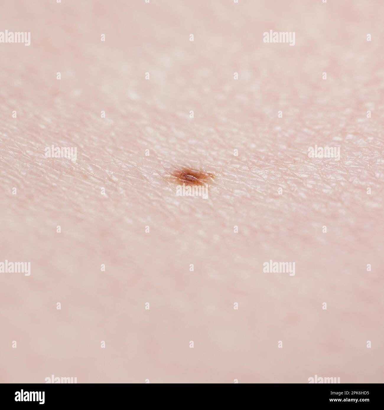 close-up of human skin with small mole or nevus Stock Photo - Alamy