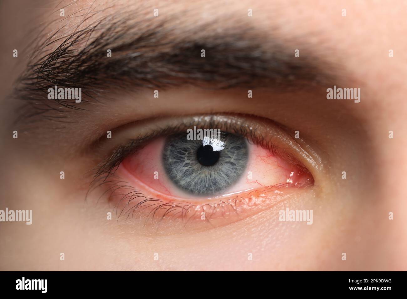 Inflamed eye hi-res stock photography and images - Alamy