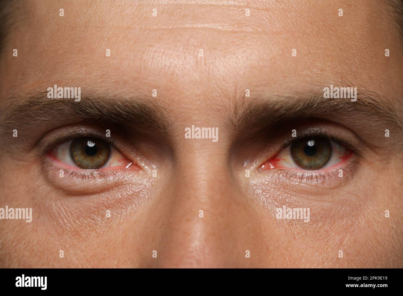 Closeup view of man with inflamed eyes Stock Photo - Alamy