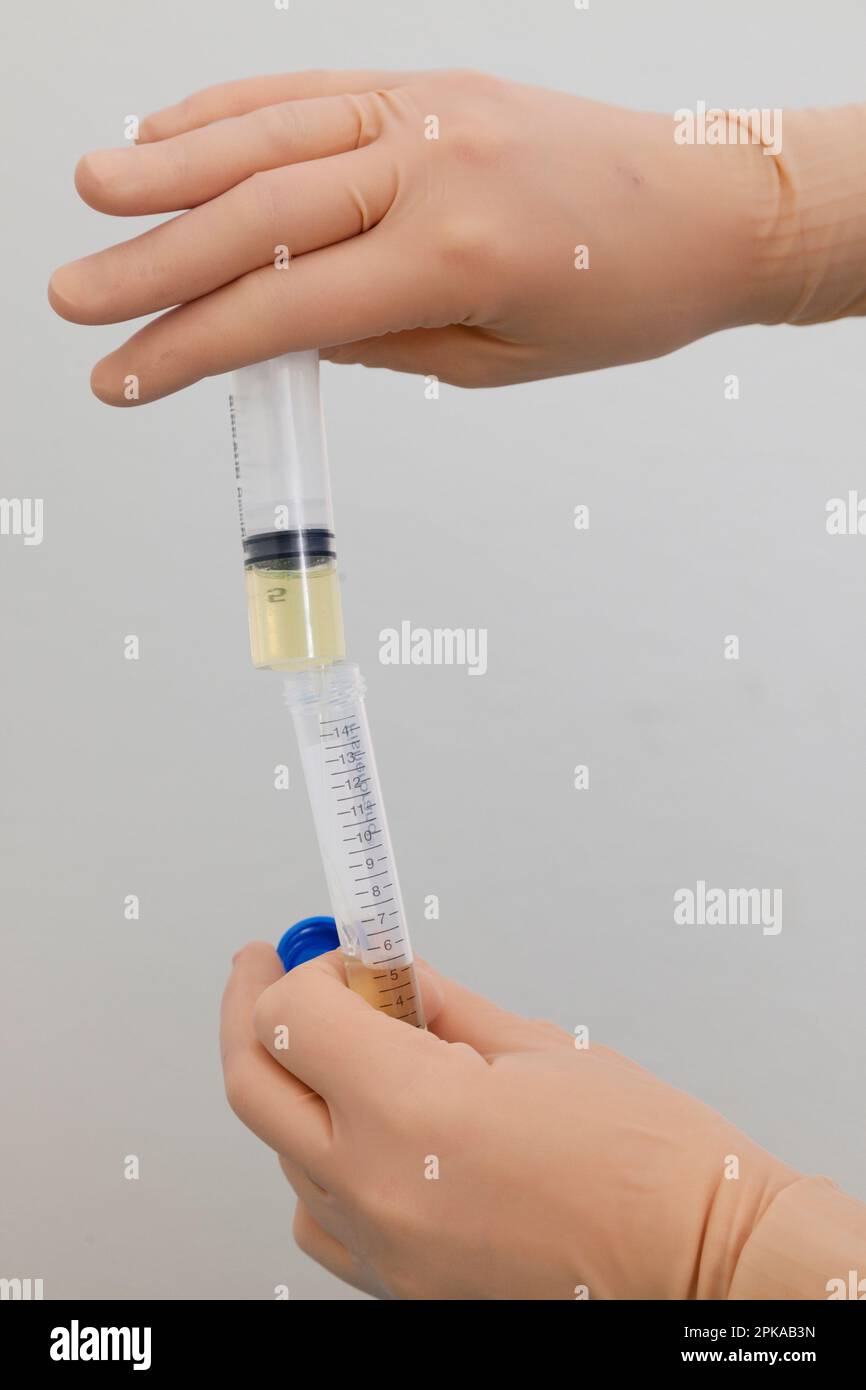 Fetal medicine: amniocentesis and study of the karyotype Stock Photo ...