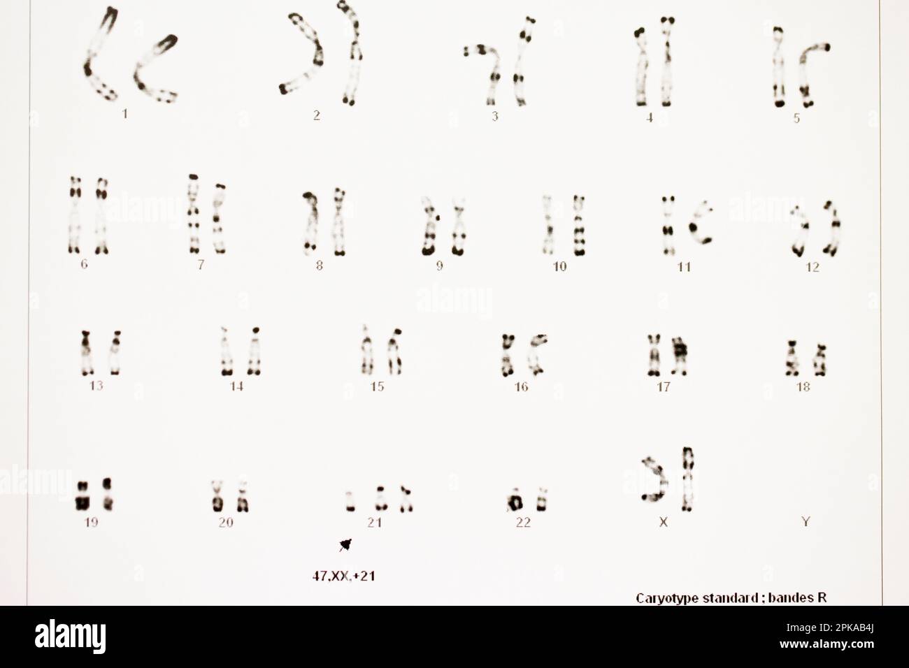 Fetal medicine: amniocentesis and study of the karyotype Stock Photo ...