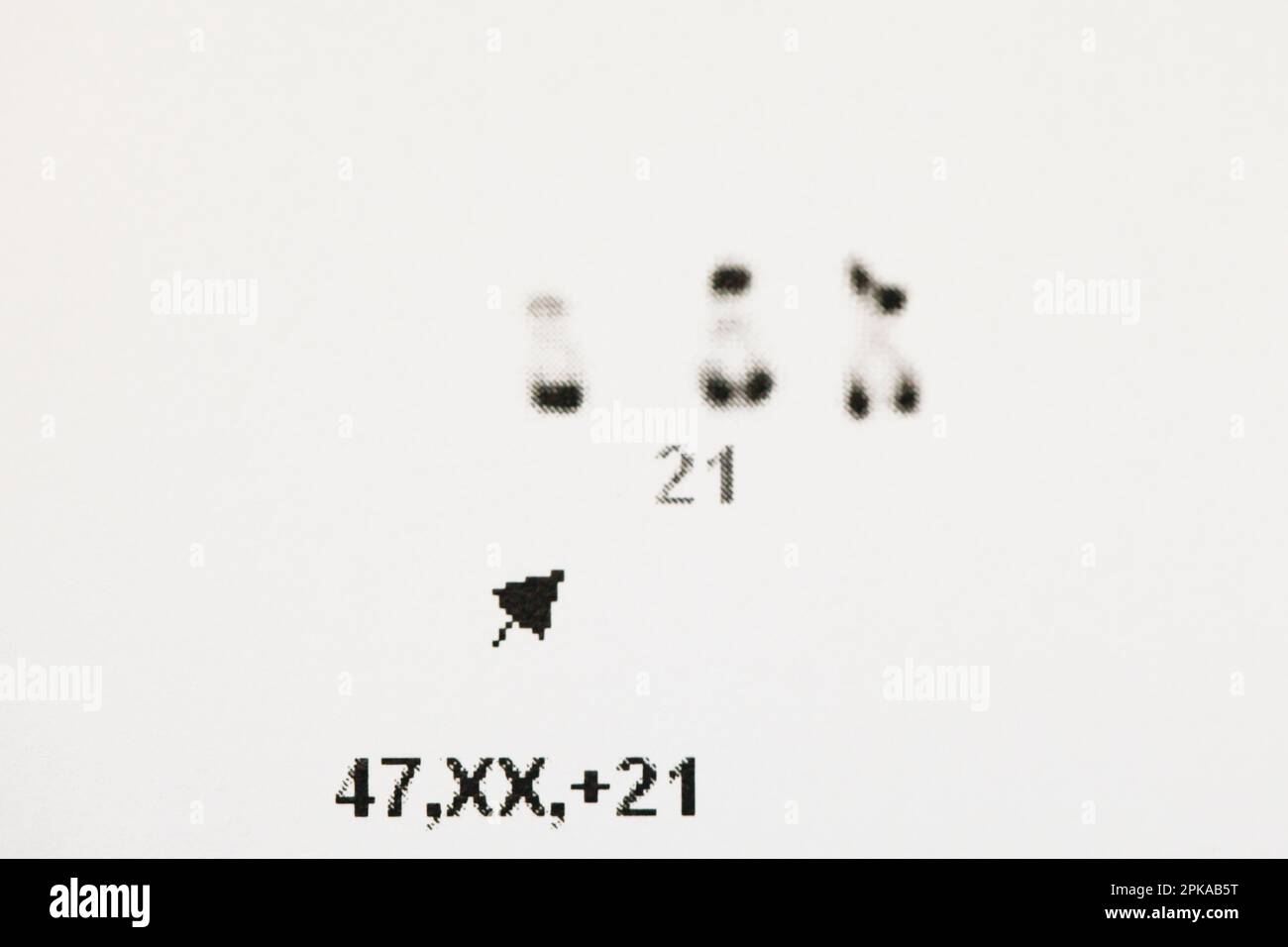Monosomy 21 Karyotype