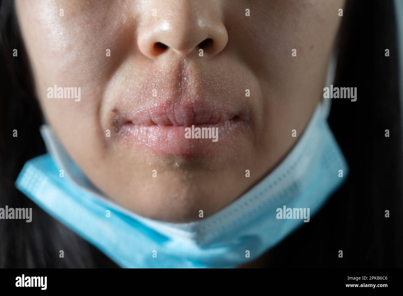Skin irritation hi-res stock photography and images - Alamy