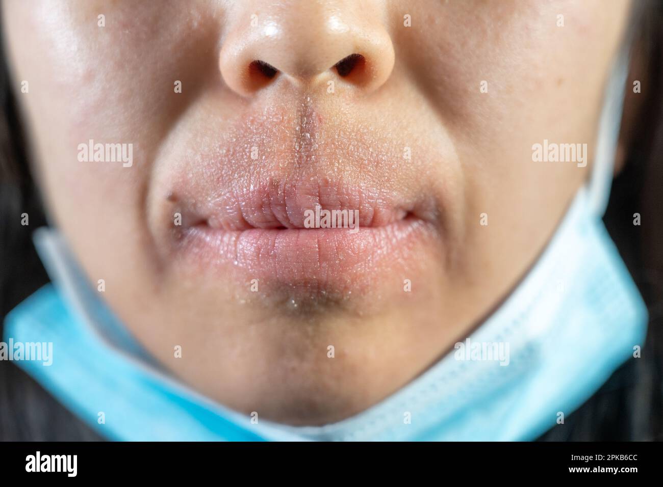 Skin irritation due to wearing a mask Stock Photo - Alamy