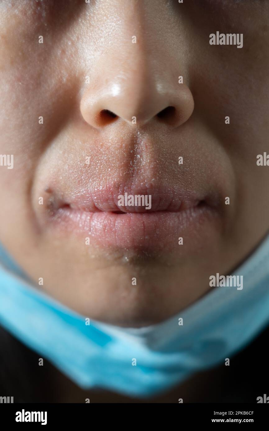 Skin irritation due to wearing a mask Stock Photo - Alamy