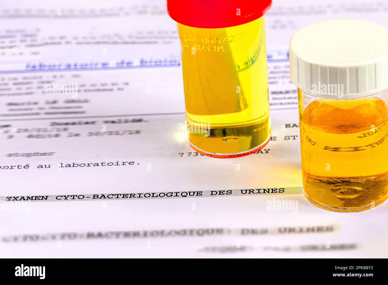 Two vials of urine placed on an analysis result Stock Photo - Alamy