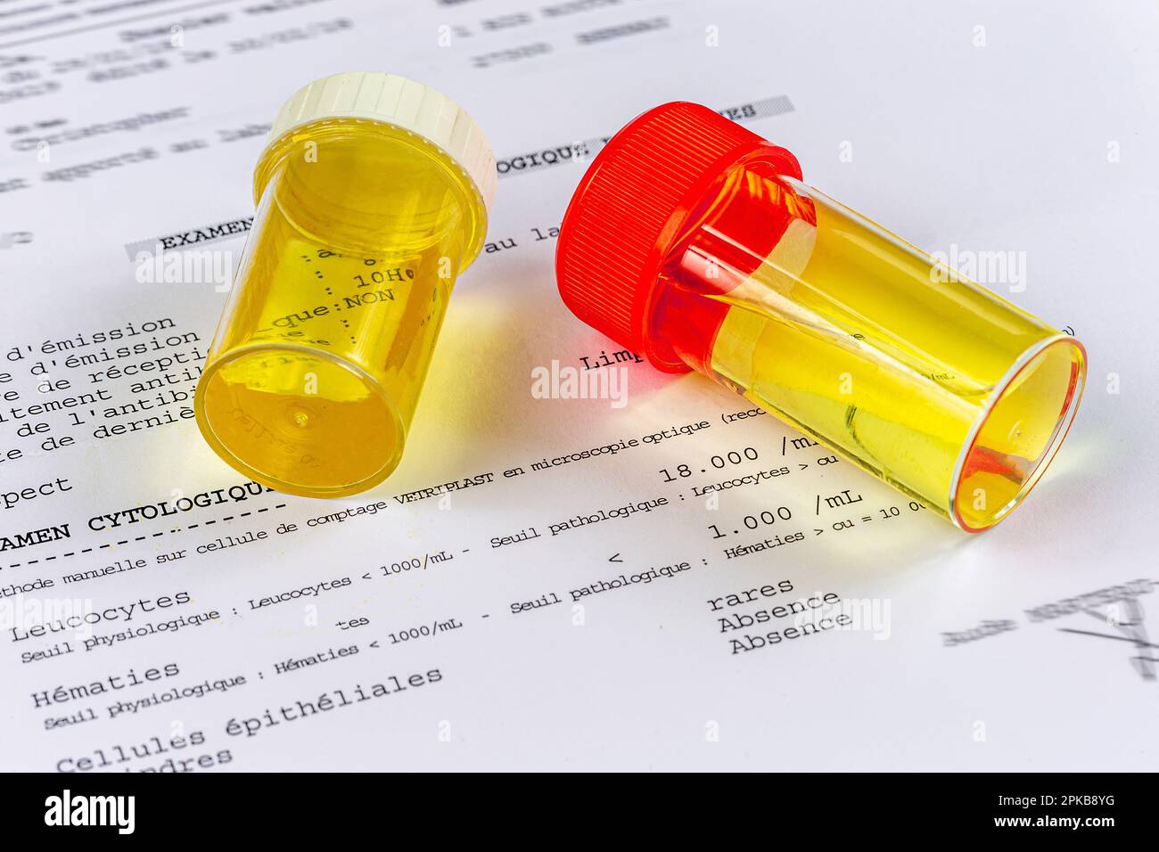 Two vials of urine placed on an analysis result Stock Photo - Alamy