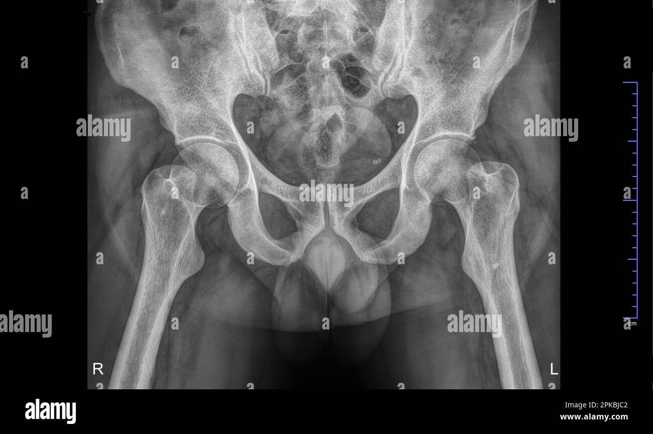 X-ray radiograph of the pelvis and hips of a man Stock Photo - Alamy