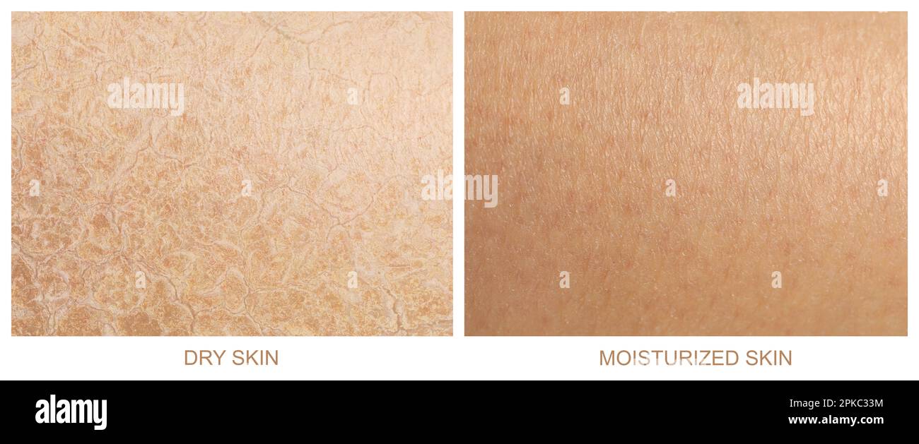 Collage with photos of dry and moisturized human skin, closeup. Banner ...