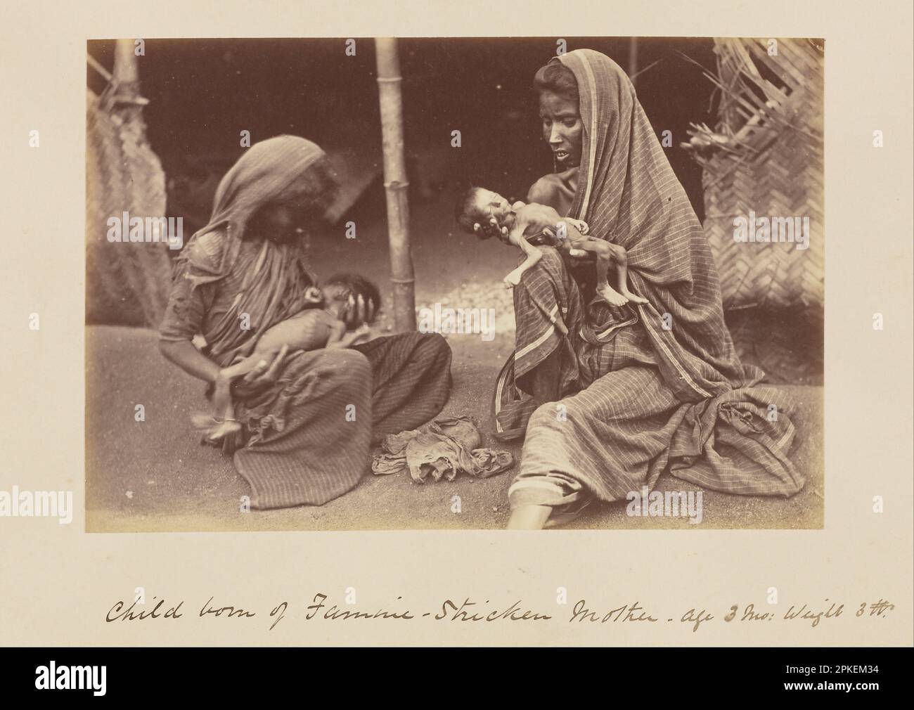 Child Born of Famine-Stricken Mother - Age: 3 months, Weight: 3 lbs ...