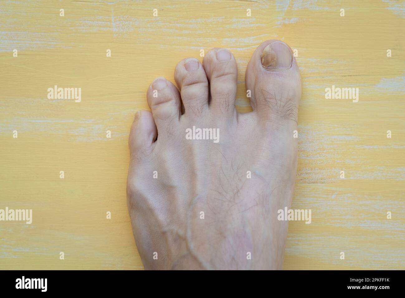Toenails with fungus problems,Onychomycosis, also known as tinea ...