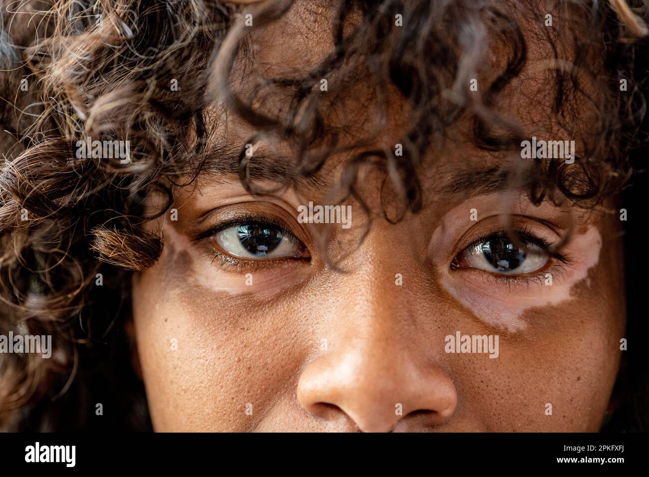 Portrait of young Brazilian woman with Vitiligo on face and eyes ...