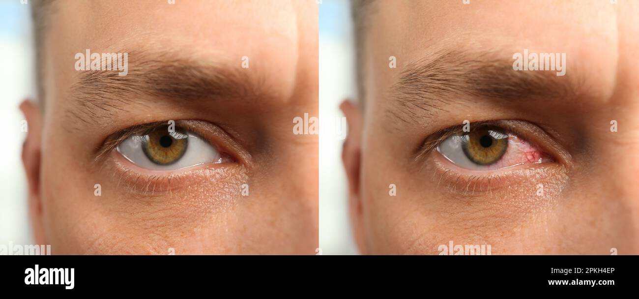 Healthy Eye Bags