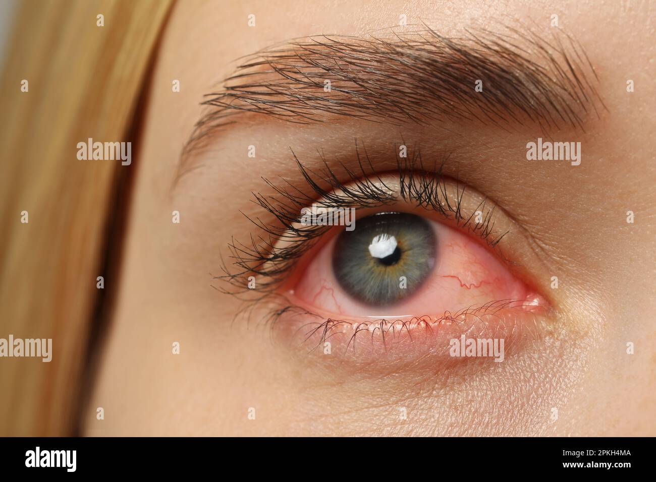 Closeup view of woman with inflamed eyes Stock Photo - Alamy