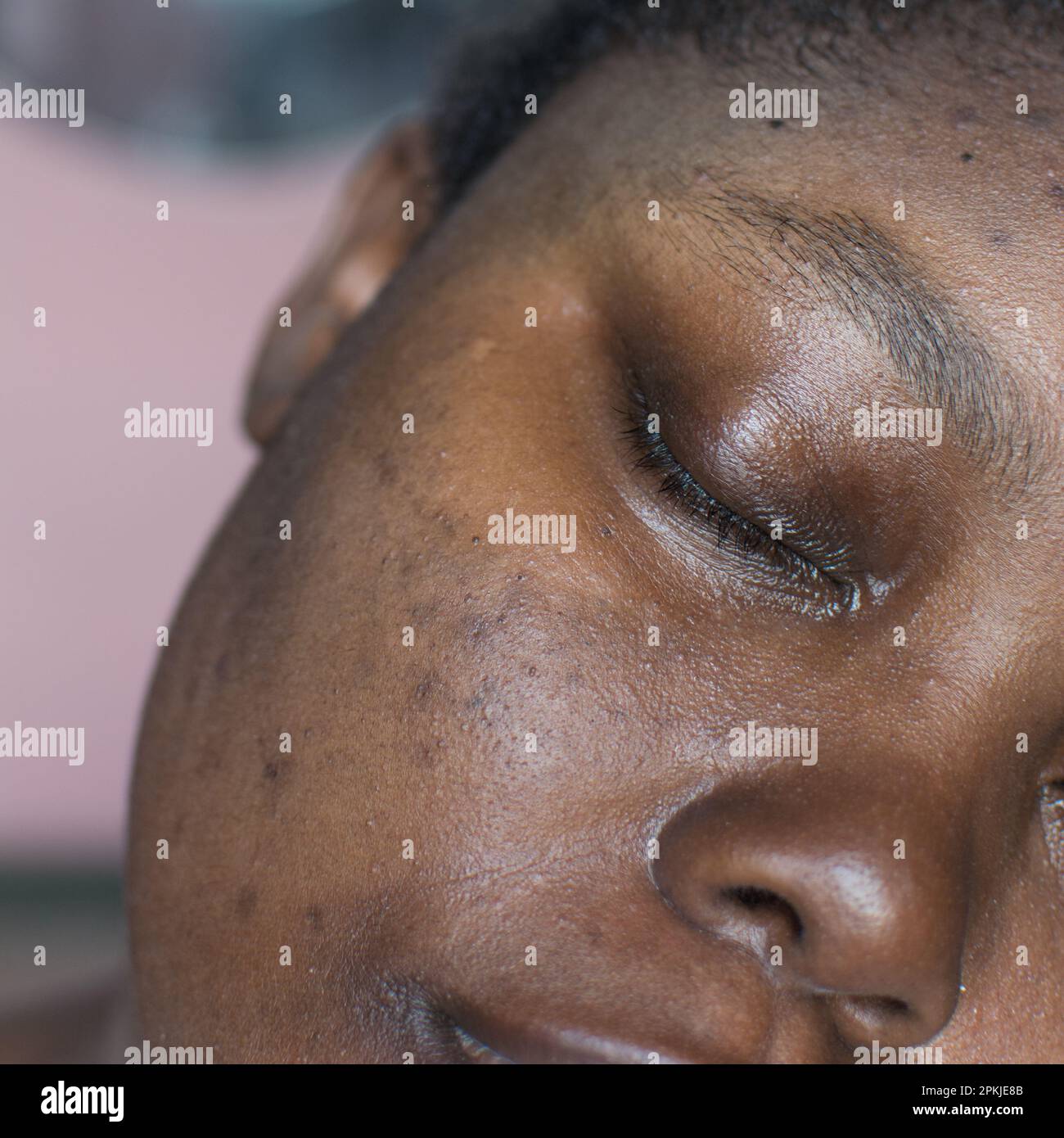 Brown skin with dark spots, hyperpigmentation on brown skin, african ...