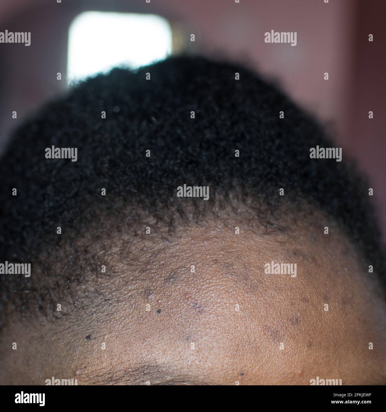 Brown skin with dark spots, hyperpigmentation on brown skin, african ...