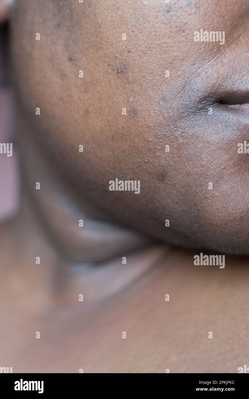 Hyperpigmentation dark spots hi-res stock photography and images - Alamy