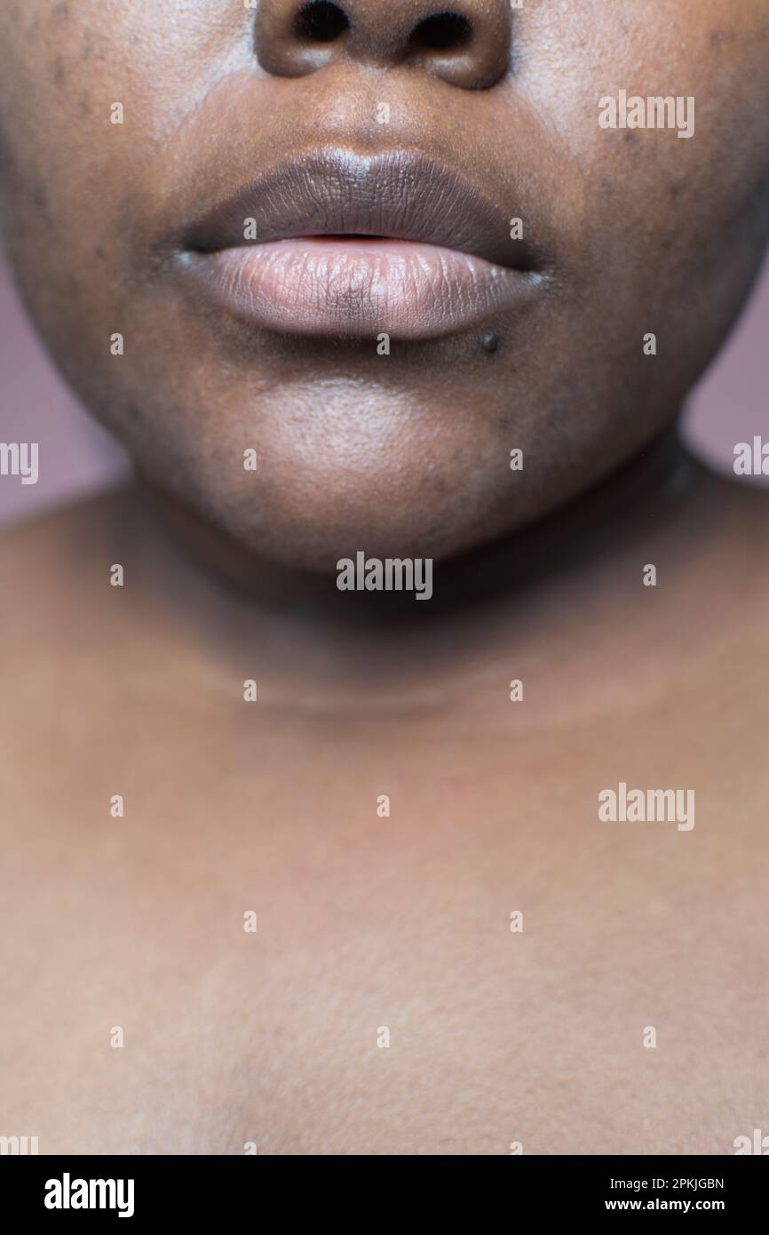 Brown skin with dark spots, hyperpigmentation on brown skin, african ...