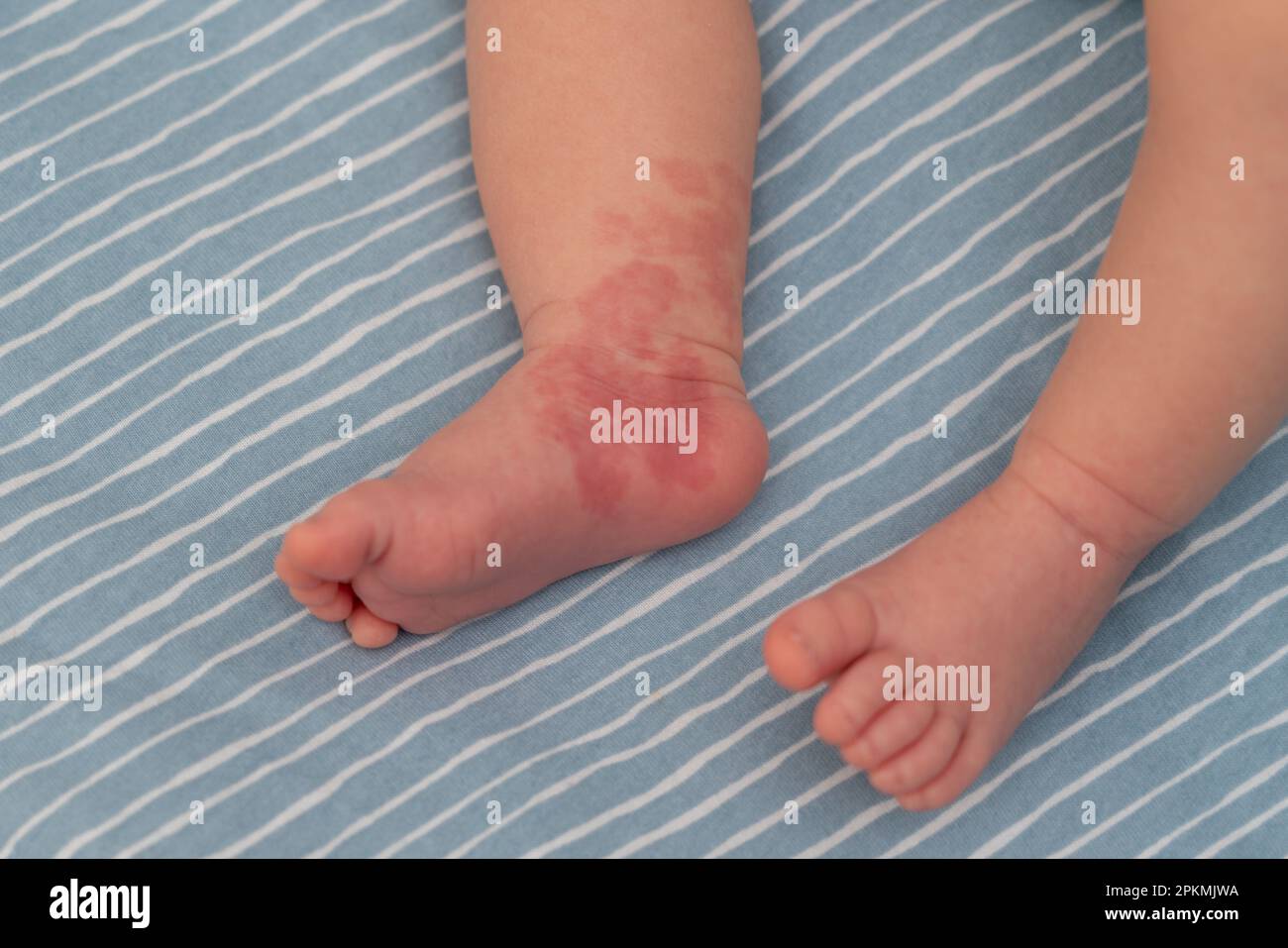 Hemangioma birth mark hi-res stock photography and images - Alamy