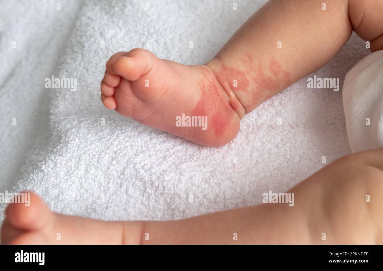 Hemangioma red birthmark on the leg of newborn baby Stock Photo - Alamy