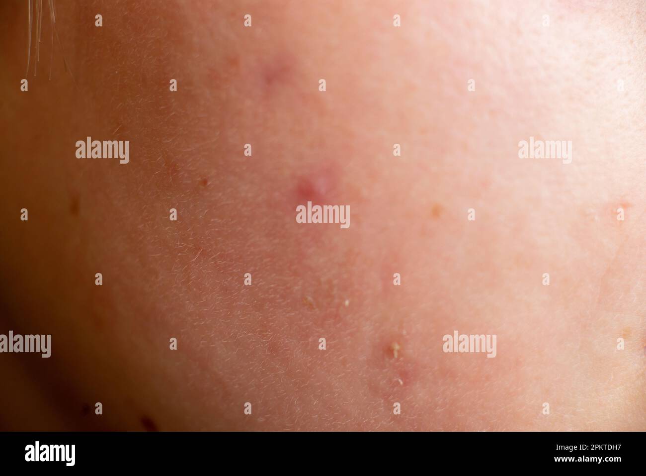 Skin with close-up macro pimples. Skin problems, dermatology Stock ...