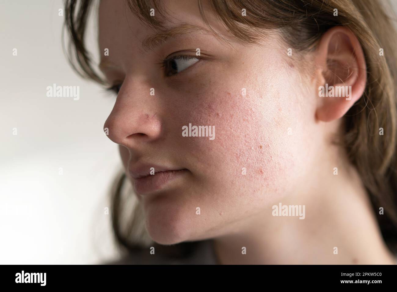 Problem skin face. A teenage girl with a troubled face Stock Photo - Alamy