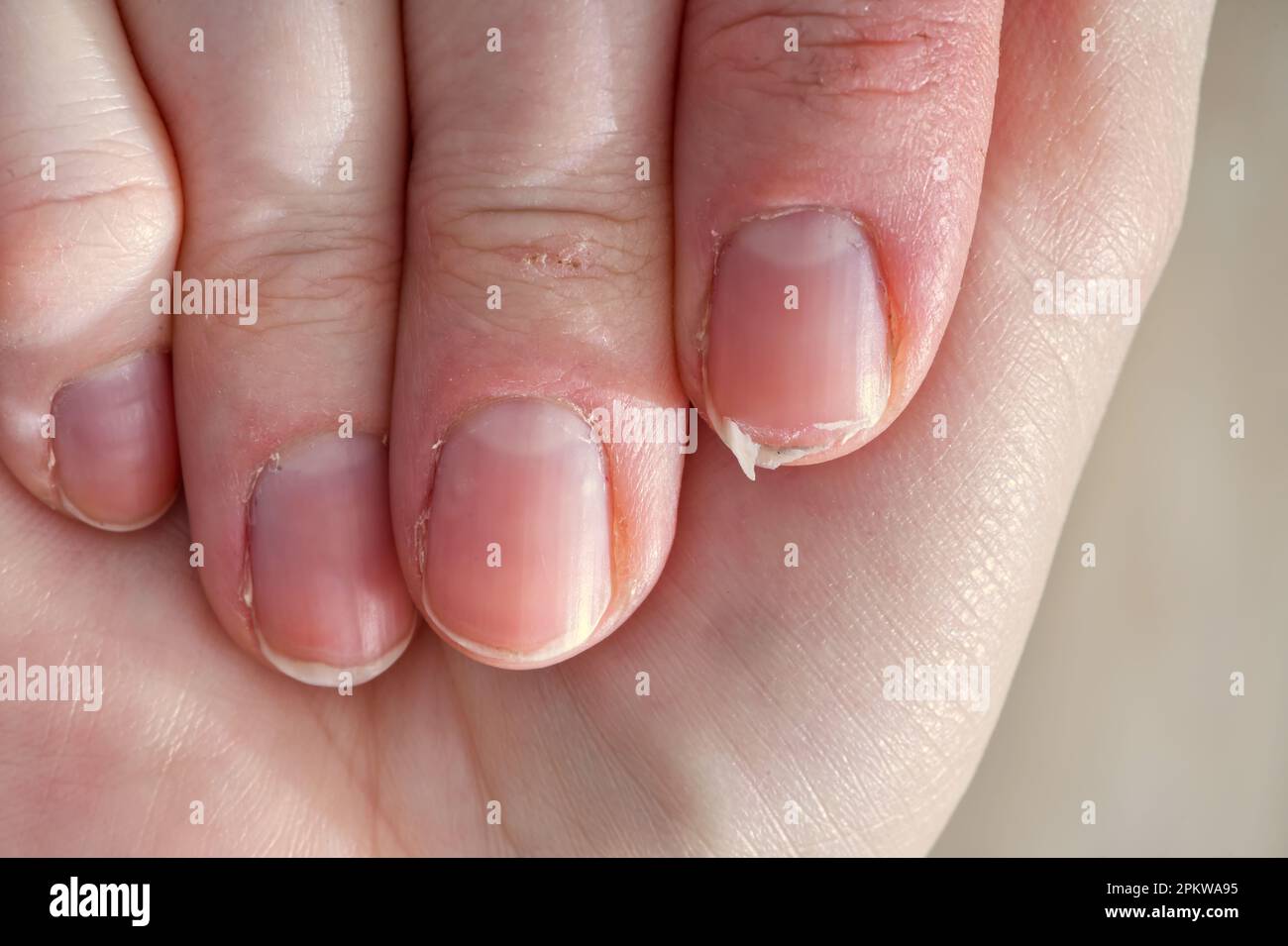 Broken fingernail hi-res stock photography and images - Alamy