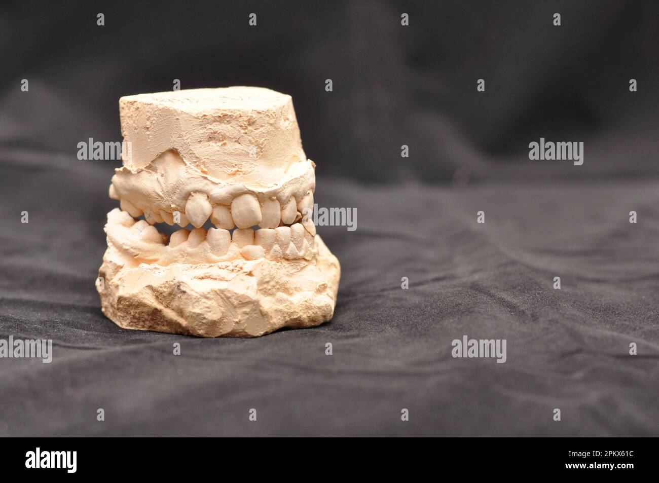 Plaster model or cast of human teeth. Strongly crooked teeth Stock ...
