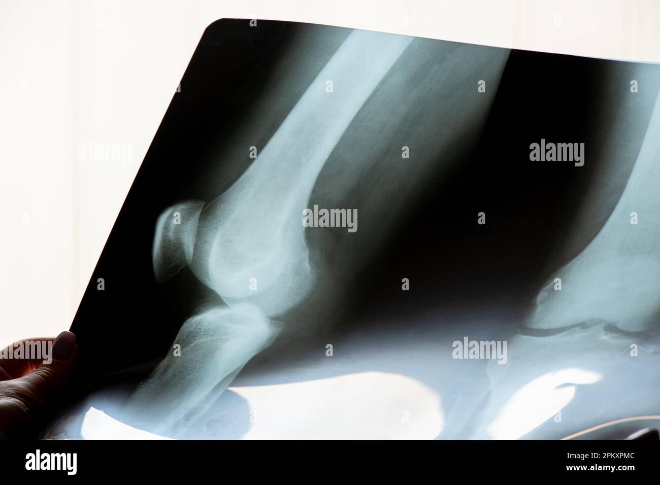 X-ray of a patient with a torn meniscus of the knee joint in a man and ...