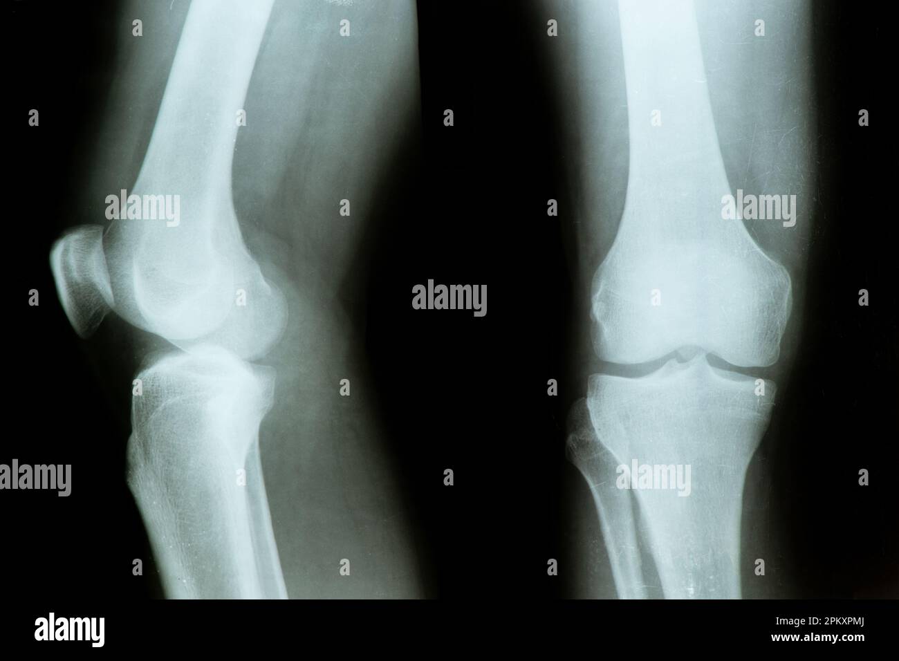 X-ray of a patient with a torn meniscus of the knee joint in a man and ...