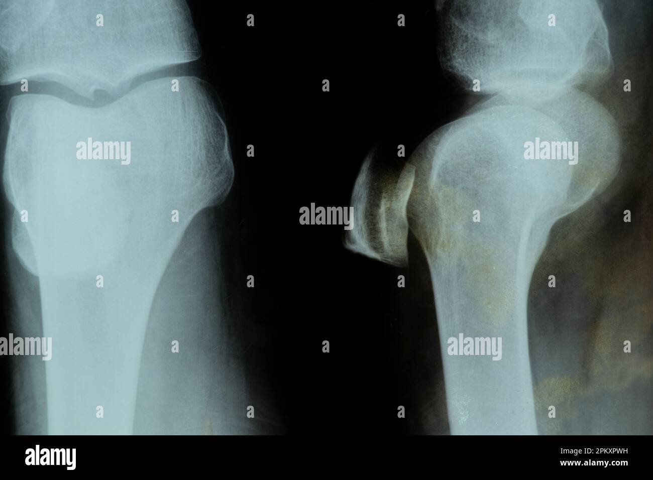 X-ray of a patient with a torn meniscus of the knee joint in a man and ...