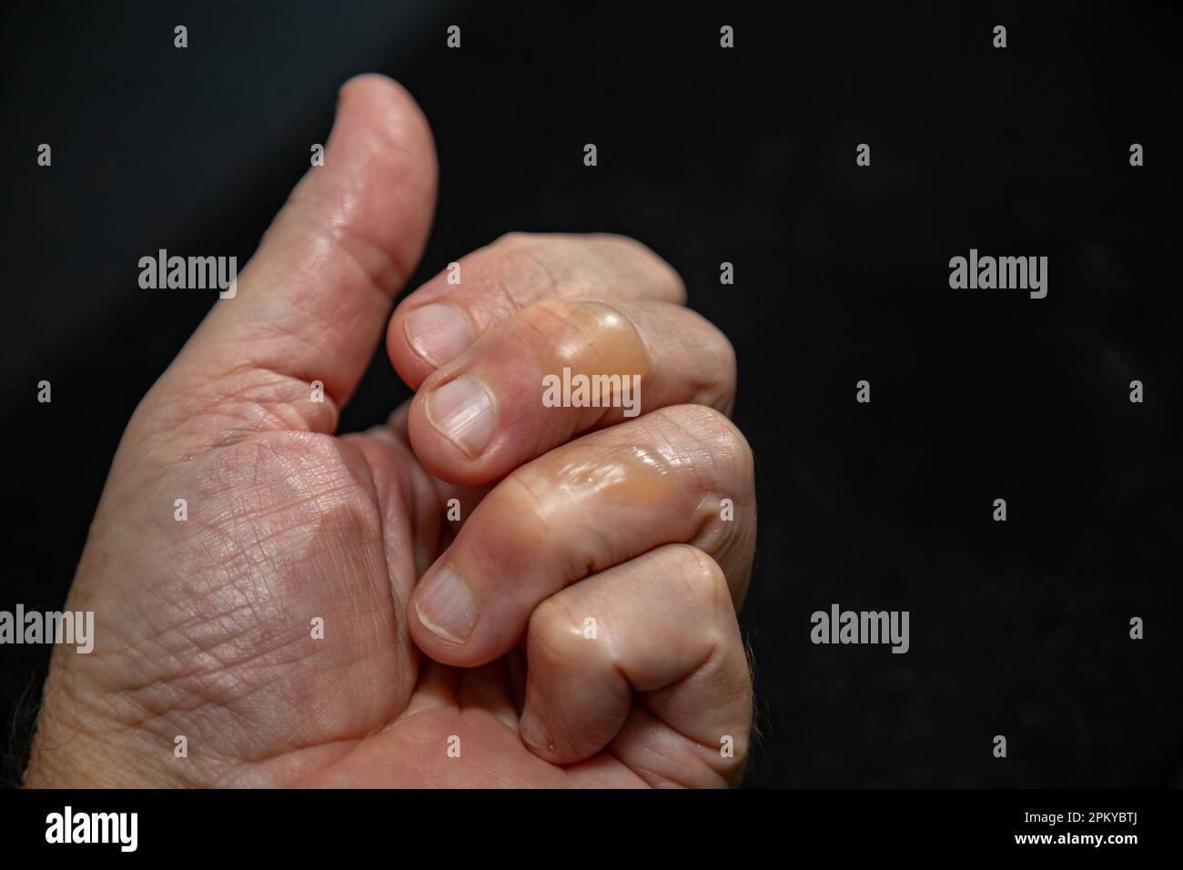 Typical skin blisters from second-degree boiling oil burns Stock Photo ...