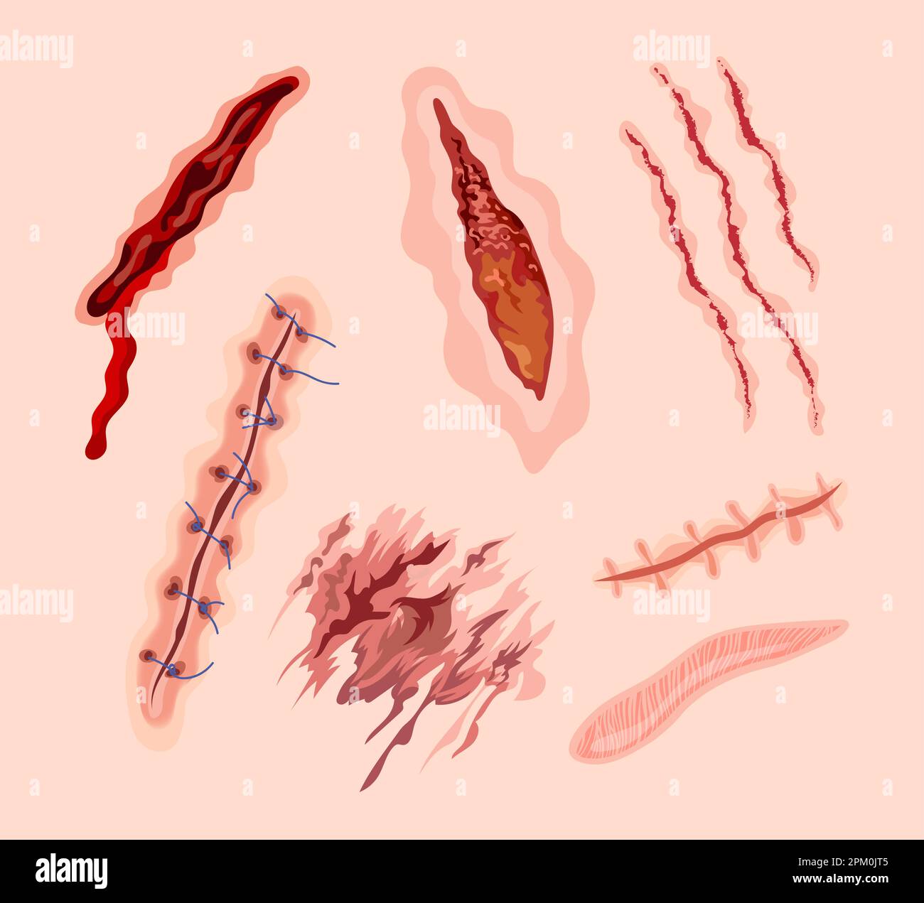 Skin scars with stitches cartoon illustration set Stock Vector Image & Art - Alamy