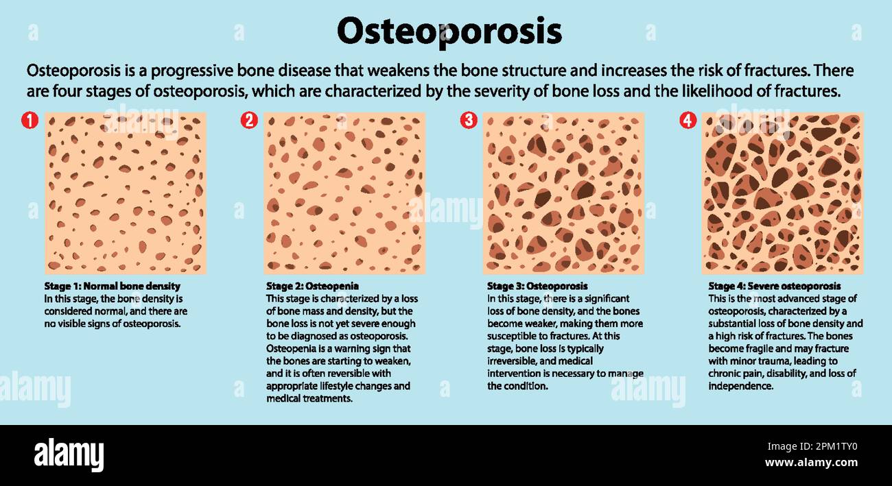 Bone Density and Osteoporosis Vector illustration Stock Vector Image ...