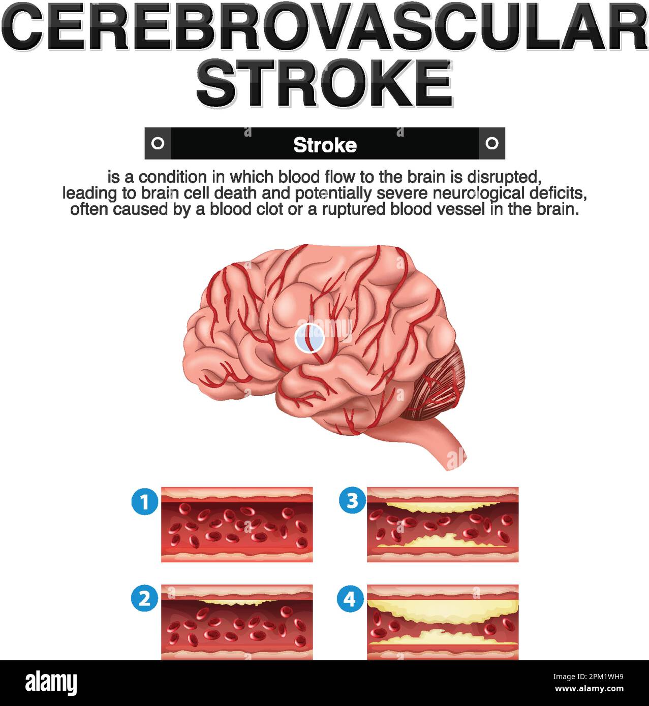 Cerebrovascular Stock Vector Images - Alamy