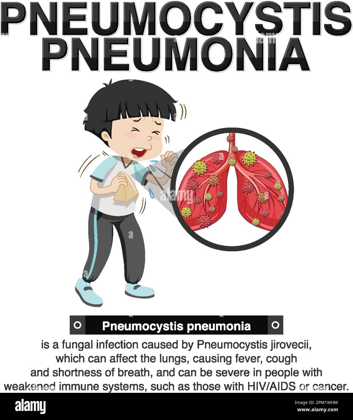 Informative poster of Pneumocystis Pneumonia illustration Stock Vector ...